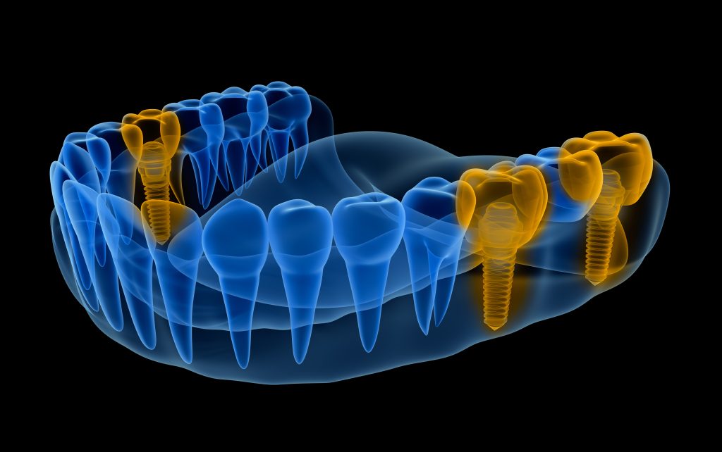 Implantes Dentales: Mucho Más que Dientes Artificiales | Clínica dental ...